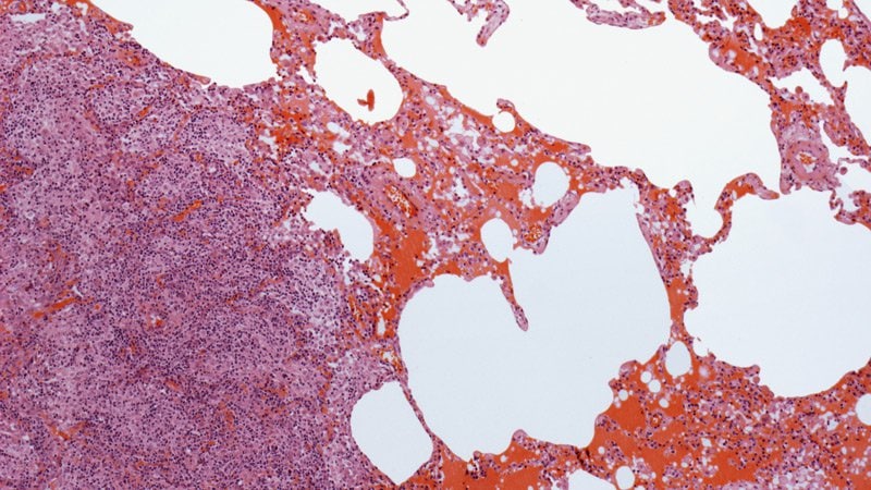 Mulher de 42 anos com tosse crônica e produtiva - Page 2