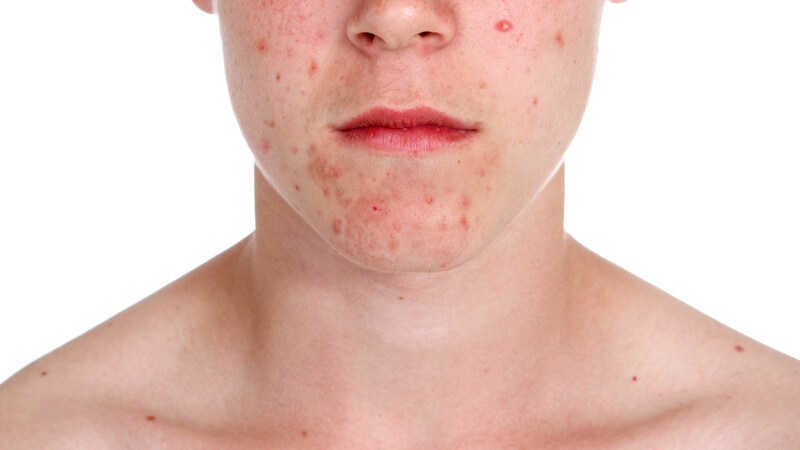 Isotretinoína para acne: quais são as evidências?