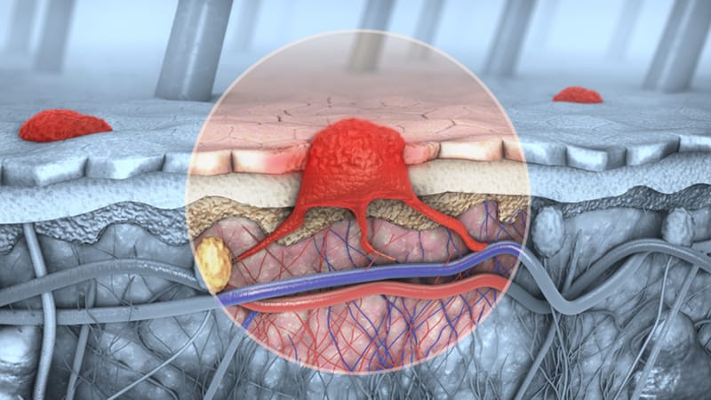 Um em cada dois pacientes com melanoma metastático segue vivo após 5 anos