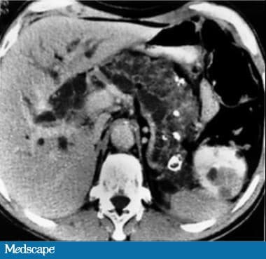 Adolescente de 15 anos com esteatorreia e cegueira noturna - Page 2