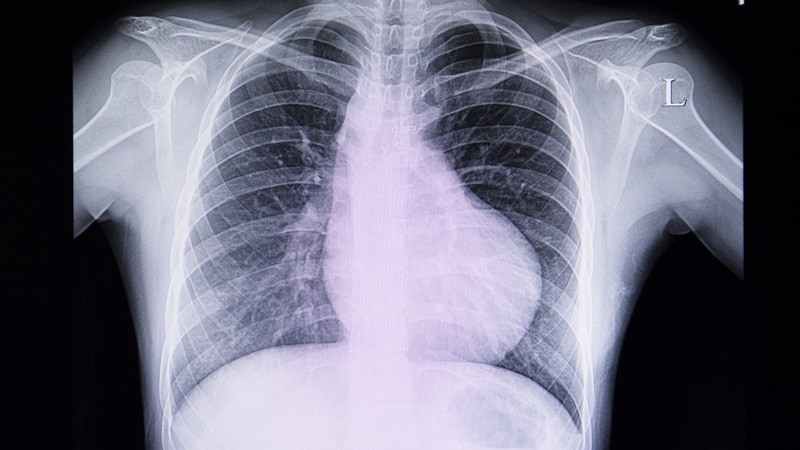 Nova opção terapêutica na cardiomiopatia hipertrófica