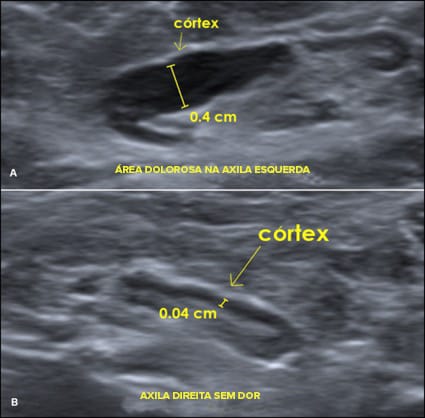 Edema axilar doloroso após a vacina anticovídica: o que fazer?