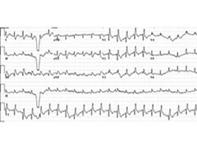 Conheça a abordagem correta na insuficiência ventricular direita