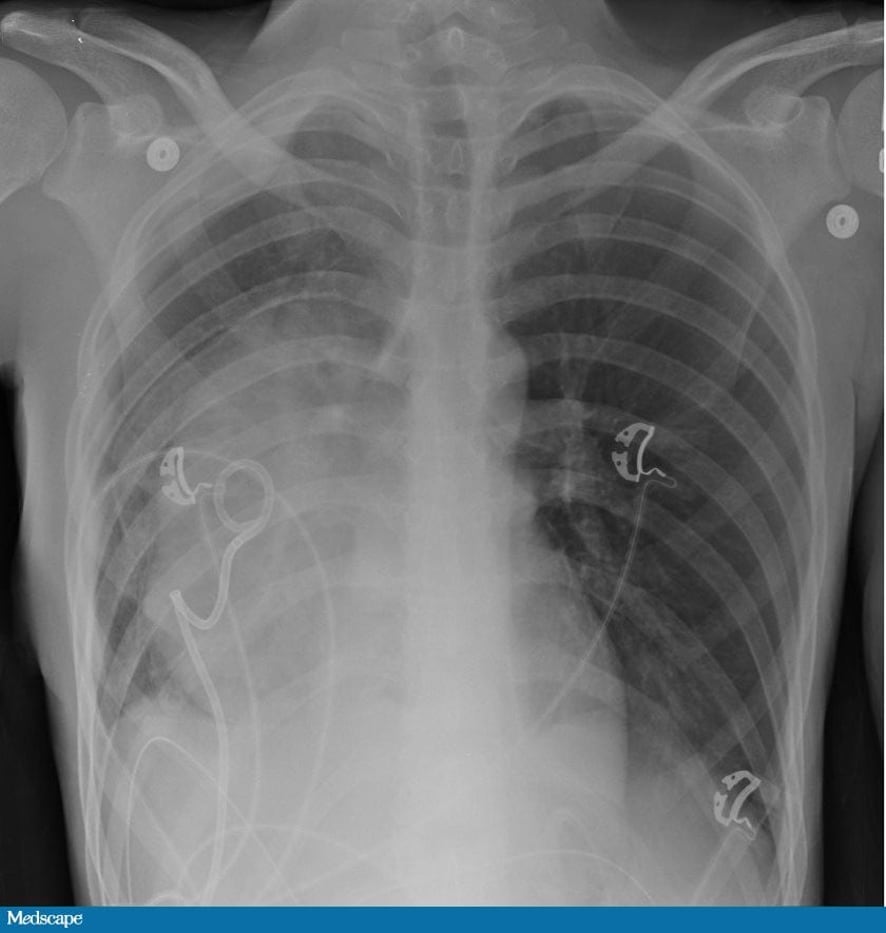 Derrame Pleural Com Cateter Pigtail