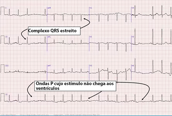 Complexo Qrs Estreito