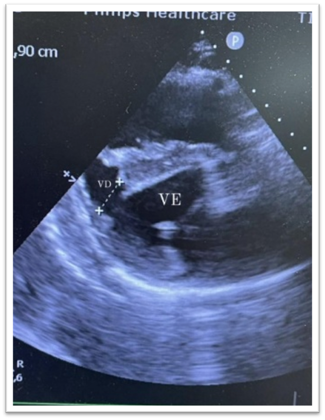 Caso Clínico: Homem de 46 anos apresenta dor torácica retroesternal com ...