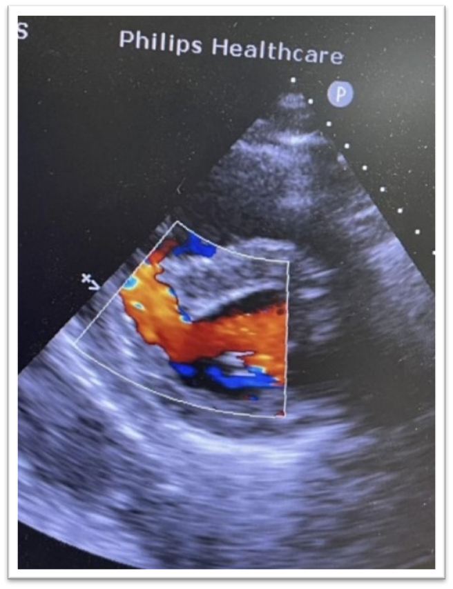 Caso Clínico: Homem de 46 anos apresenta dor torácica retroesternal com ...