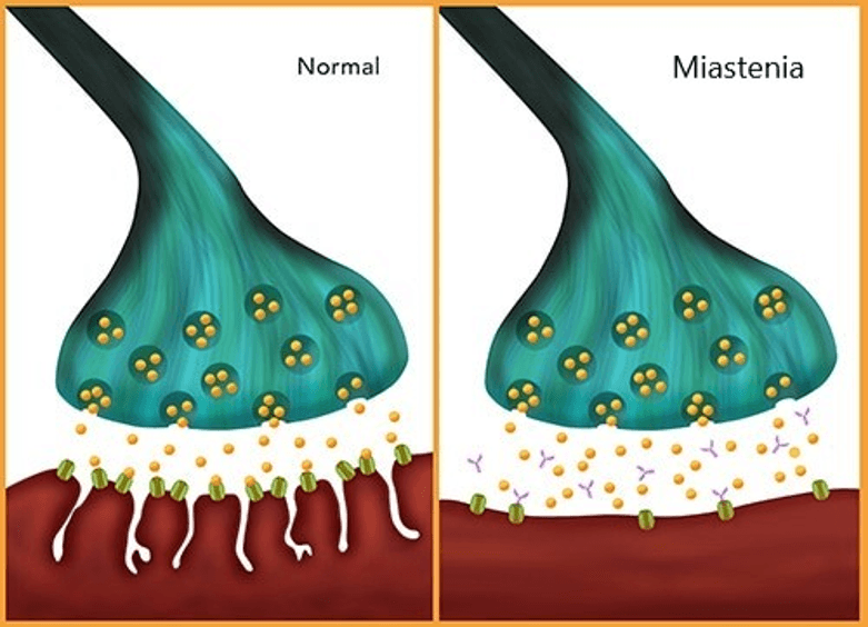 Teste Rápido: Fisiopatologia da miastenia grave