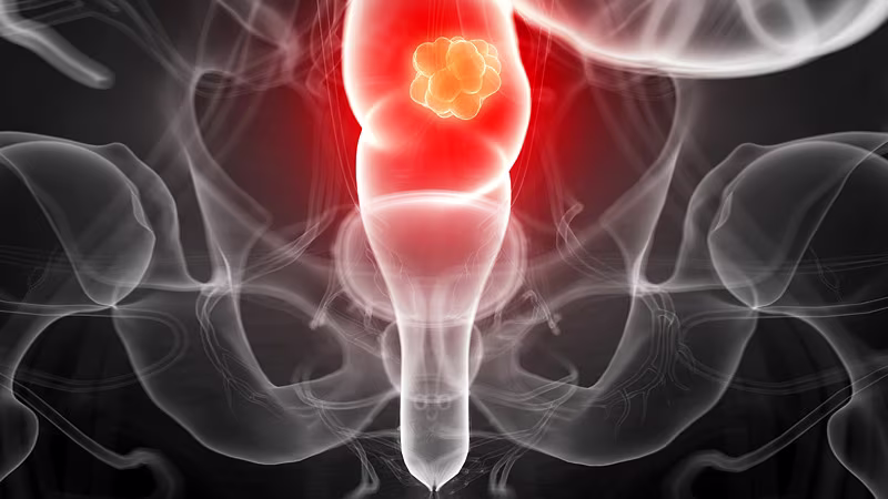 Crescimento tumoral após tratamento neoadjuvante do câncer retal em ...