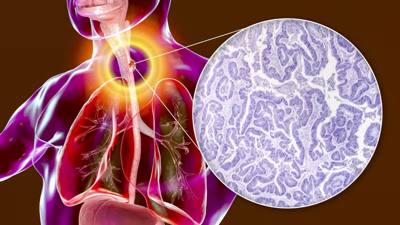Câncer de esôfago: abordagem cirúrgica dispensável em alguns casos?