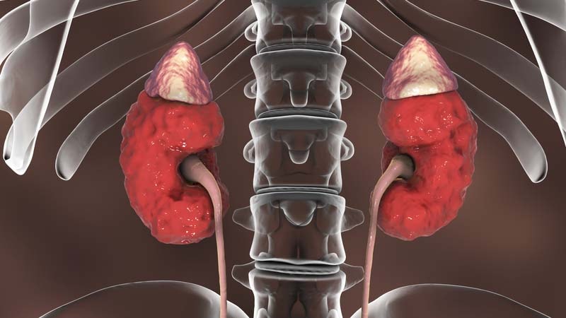 Doença renal crônica: tratmentos promissores despontam no horizonte