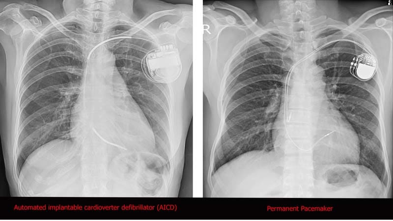 CDI subcutâneo no mundo real: um tratamento promissor?