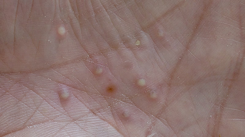 Questões acerca da pustulose palmoplantar e de outras doenças ...