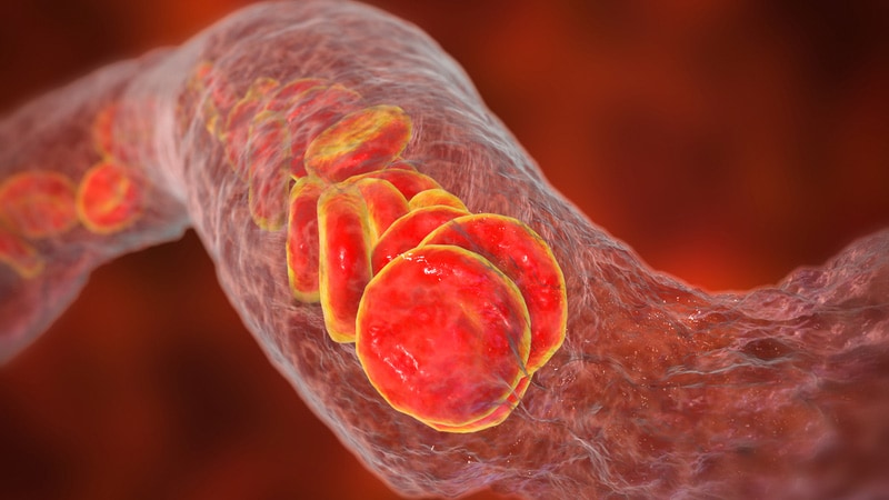 Prevenção de embolia em pacientes com cardiopatias congênitas