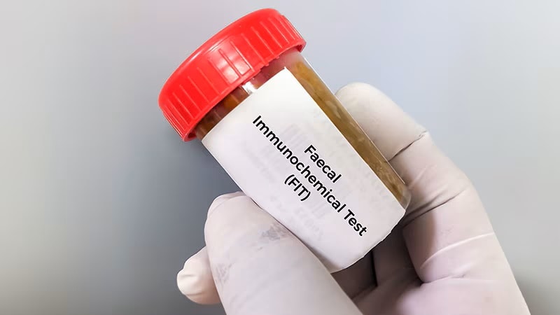 Rastreamento do CCR: novo teste de DNA fecal supera a imunoquímica em ...