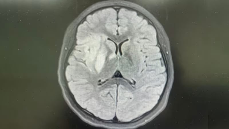 Desafio Diagnóstico: Paciente com cefaleia holocraniana e paralisia súbita