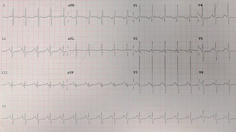 Desafio Diagnóstico: Paciente com cirrose, HIV e dependência de heroína ...