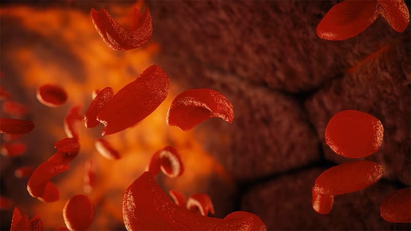Teste Rápido: Conduta na anemia falciforme