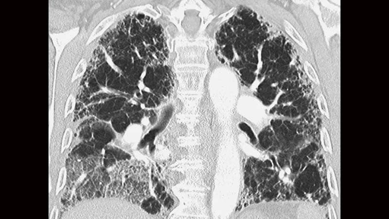 Fibrose pulmonar idiopática: razão entre neutrófilos e linfócitos pode ...