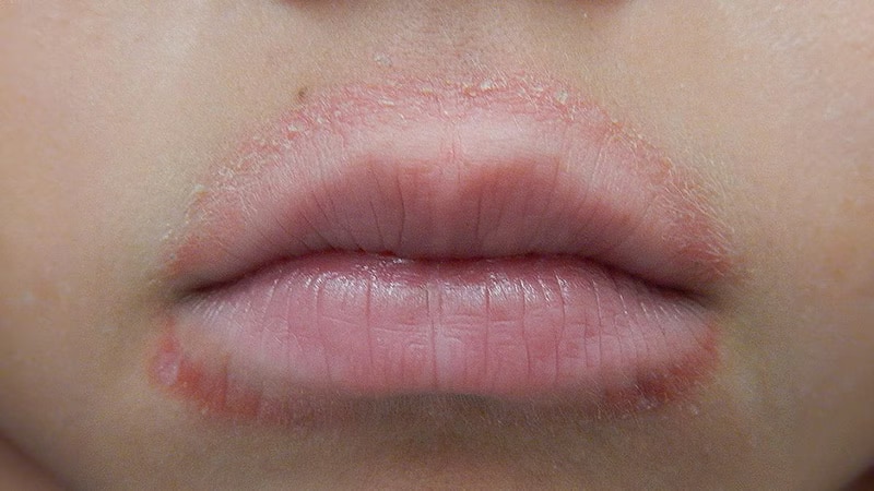 Dermatite Perioral Em Criancas