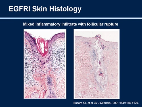 Management of Dermatologic and Other Toxicities Associated With EGFR ...
