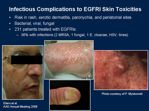 Management of Dermatologic and Other Toxicities Associated With EGFR ...