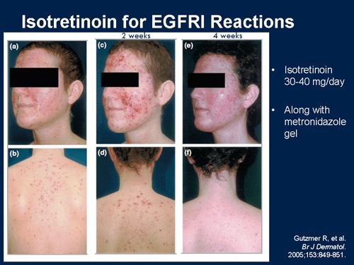 Management of Dermatologic and Other Toxicities Associated With EGFR ...