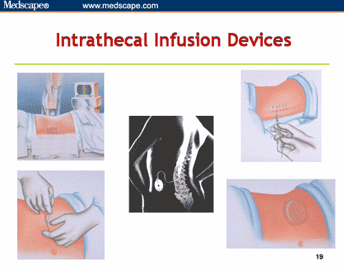 Managing Chronic Pain: Guidelines for Primary Care Physicians (Archived ...