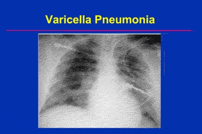 Varicella Immunization: Current Status and Practice