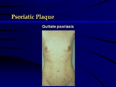 New Applications for TNF Inhibition