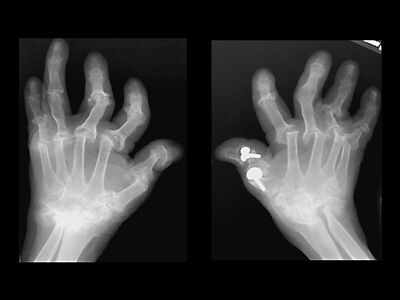 New Standards of Care for Rheumatoid Arthritis