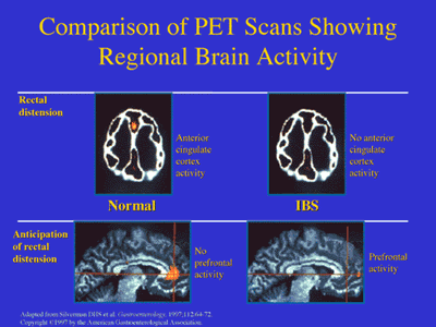 Irritable Bowel Syndrome (IBS): Examining New Findings and Treatments