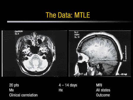 Innovative Epilepsy Therapies for the 21st Century - Part 2