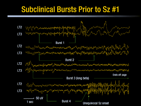 Innovative Epilepsy Therapies for the 21st Century - Part 2