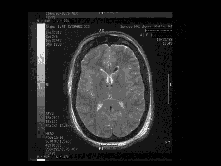Innovative Epilepsy Therapies for the 21st Century - Part 2