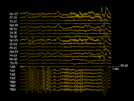 Innovative Epilepsy Therapies for the 21st Century - Part 2