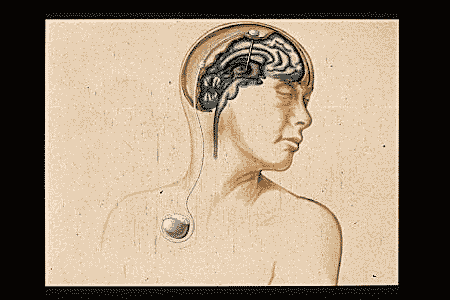 Innovative Epilepsy Therapies for the 21st Century - Part 2