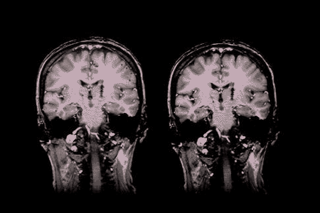 Innovative Epilepsy Therapies for the 21st Century - Part 2