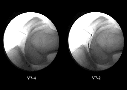 Opposing Views in the Treatment of OA of the Knee