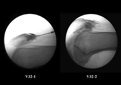 Opposing Views in the Treatment of OA of the Knee