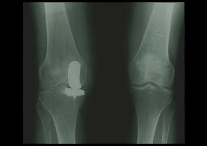 Opposing Views in the Treatment of OA of the Knee