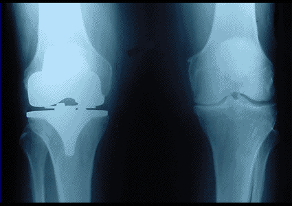 Opposing Views in the Treatment of OA of the Knee