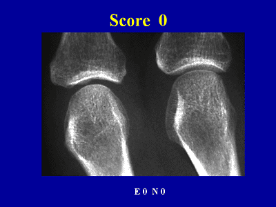 Structural Damage in Rheumatoid Arthritis