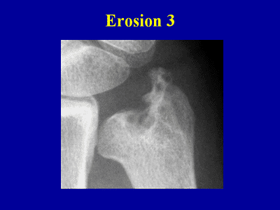 Structural Damage in Rheumatoid Arthritis