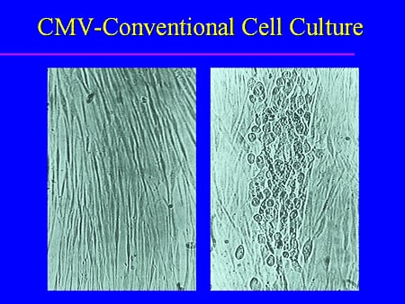 Emerging Trends in the Management of CMV After Bone Marrow...
