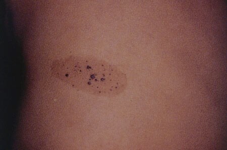 Masters of Pediatrics: Dermatology