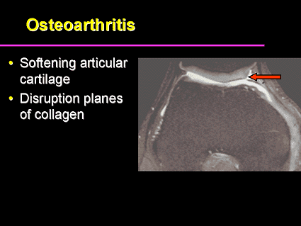 OA Today and Tomorrow: Maintaining Function with Early Intervention