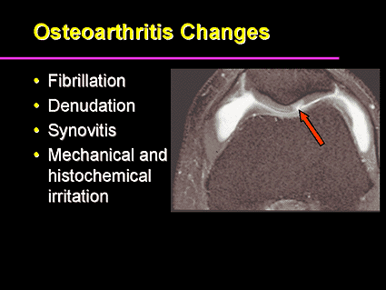 OA Today and Tomorrow: Maintaining Function with Early Intervention