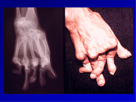 Biologic Therapies for Rheumatoid Arthritis: Navigating the Changing ...