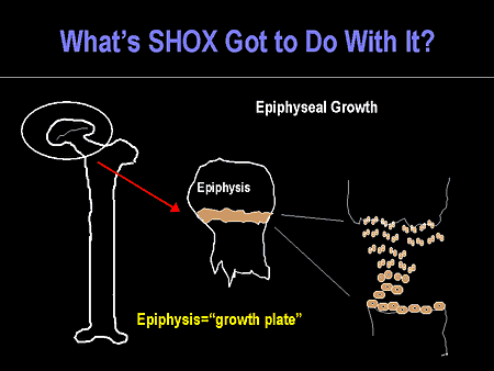 Turner Syndrome: Toward Early Recognition and Improved Outcomes